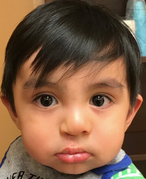 Before and After Gallery | Cleft Palate Surgeon El Paso TX