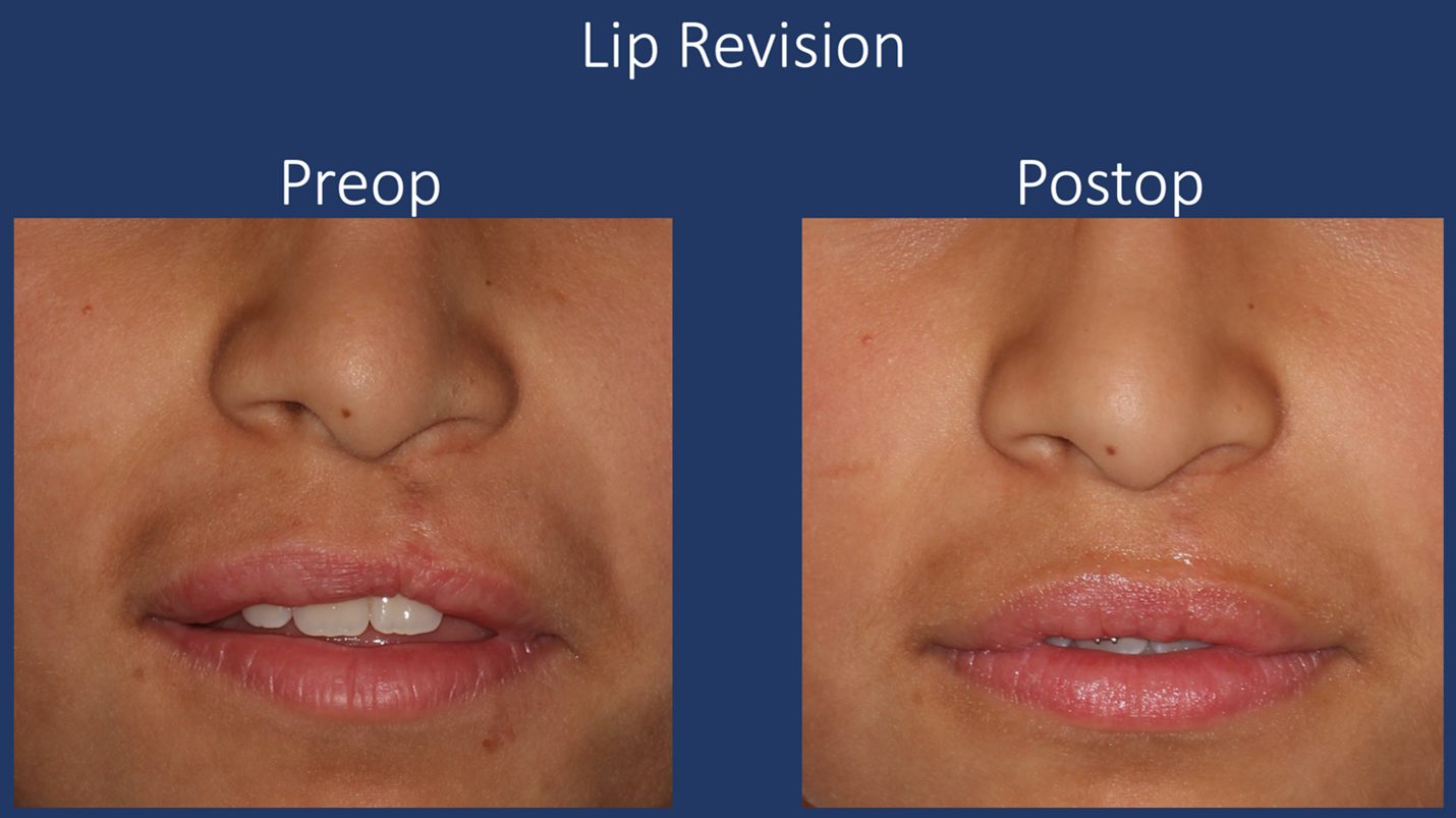 Cleft Lip Surgery Before And After