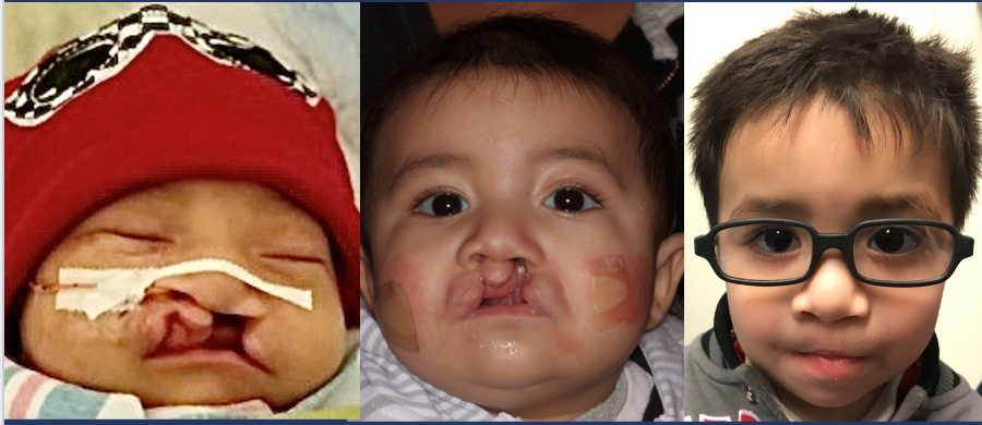 Before and After Gallery | Cleft Palate Surgeon El Paso TX